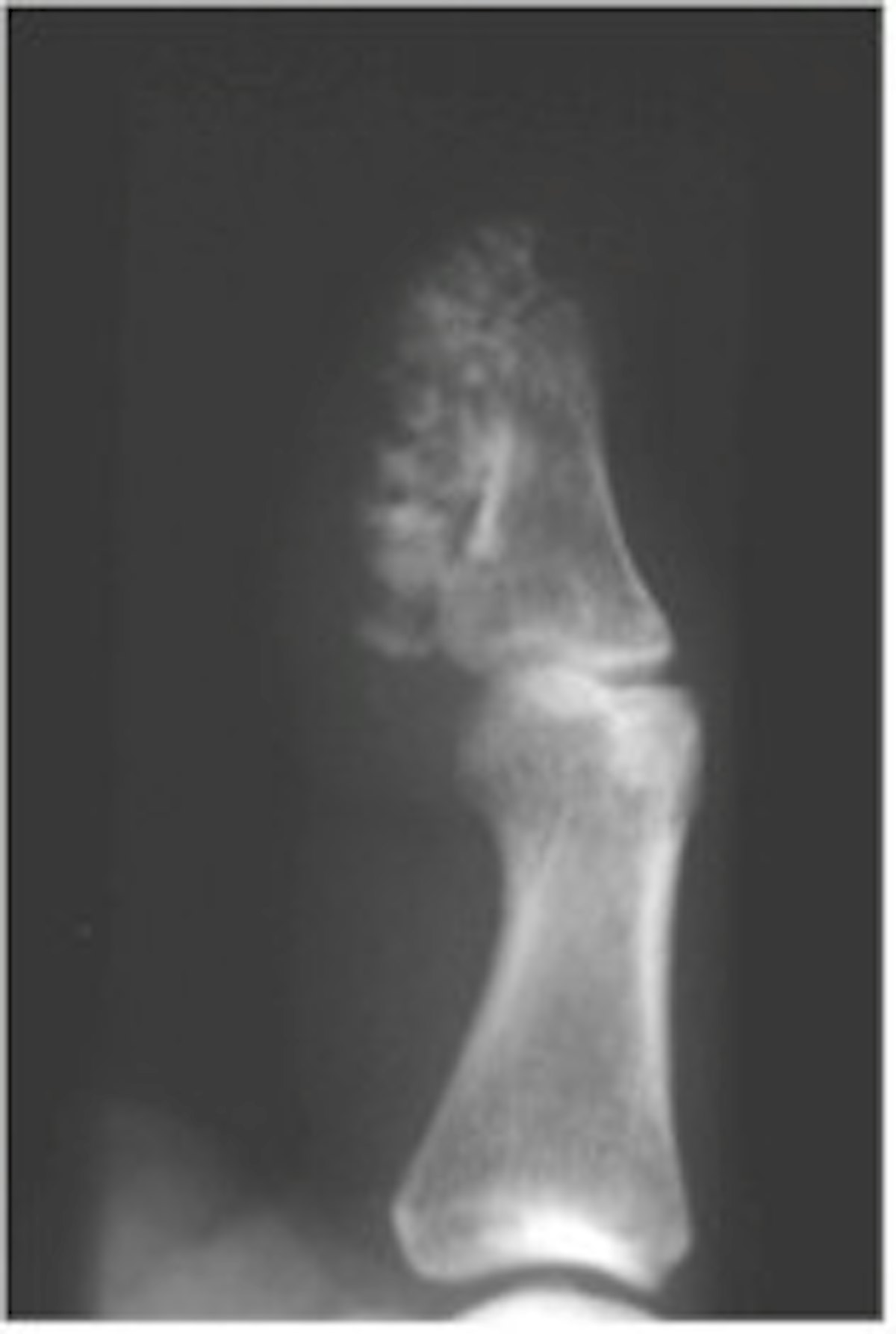 X-ray shows spray paint gun injuries close to the bone | AuntMinnie