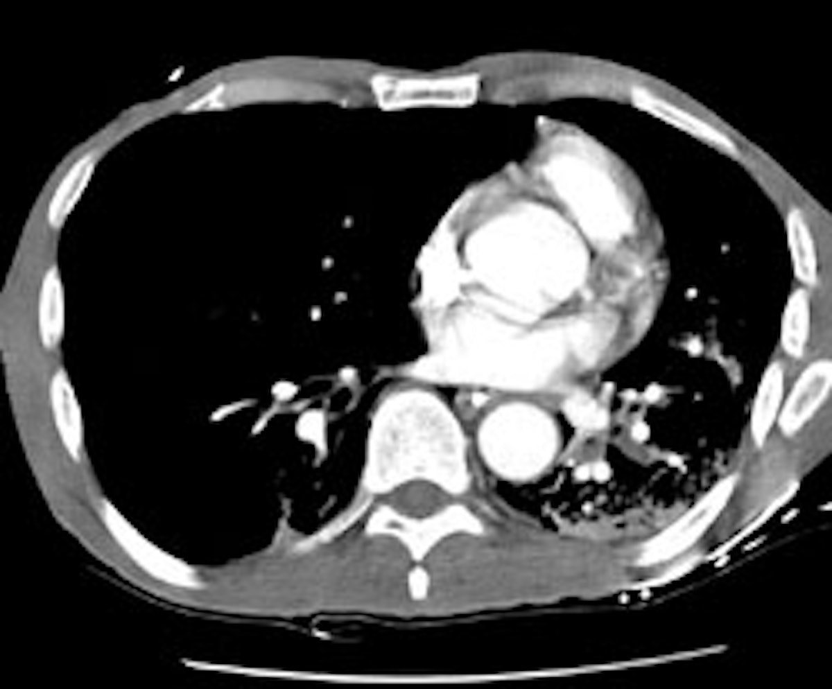 Case example PE alternative diagnosis | AuntMinnie
