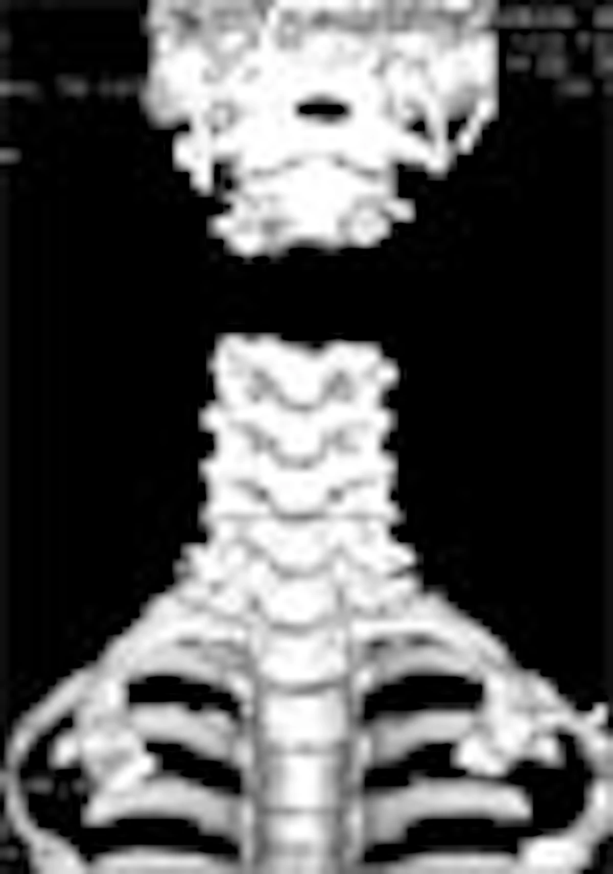 Studies and practice shape CT's role in c-spine trauma | AuntMinnie