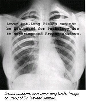 Good positioning is key to PA chest x-ray exams | AuntMinnie