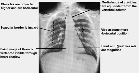 Mastering AP and lateral positioning for chest x-ray | AuntMinnie
