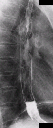 Positioning techniques for quality esophagrams | AuntMinnie