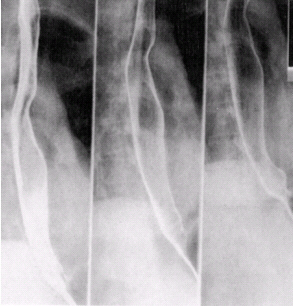 Positioning techniques for quality esophagrams | AuntMinnie