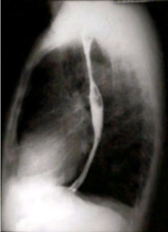 Positioning techniques for quality esophagrams | AuntMinnie