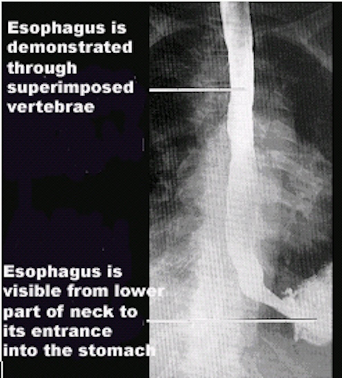 abnormal esophagram