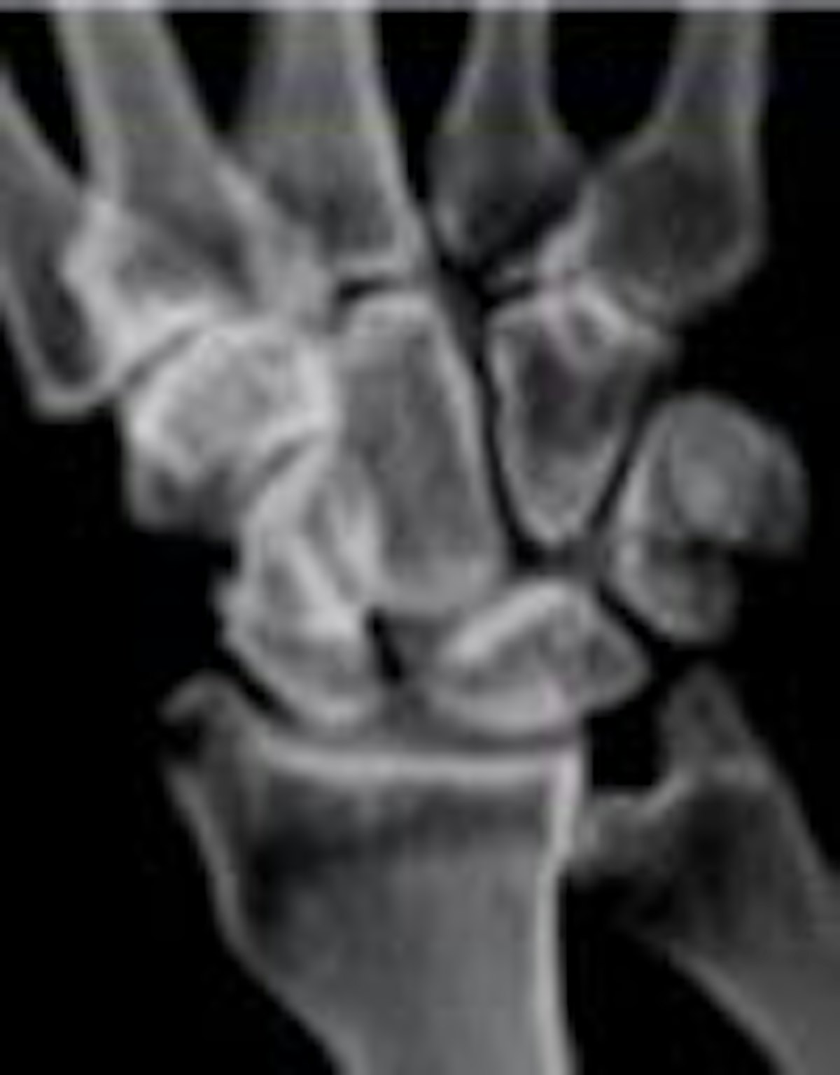 Multiplanar reformatting may reduce slice views for CT arthrography ...
