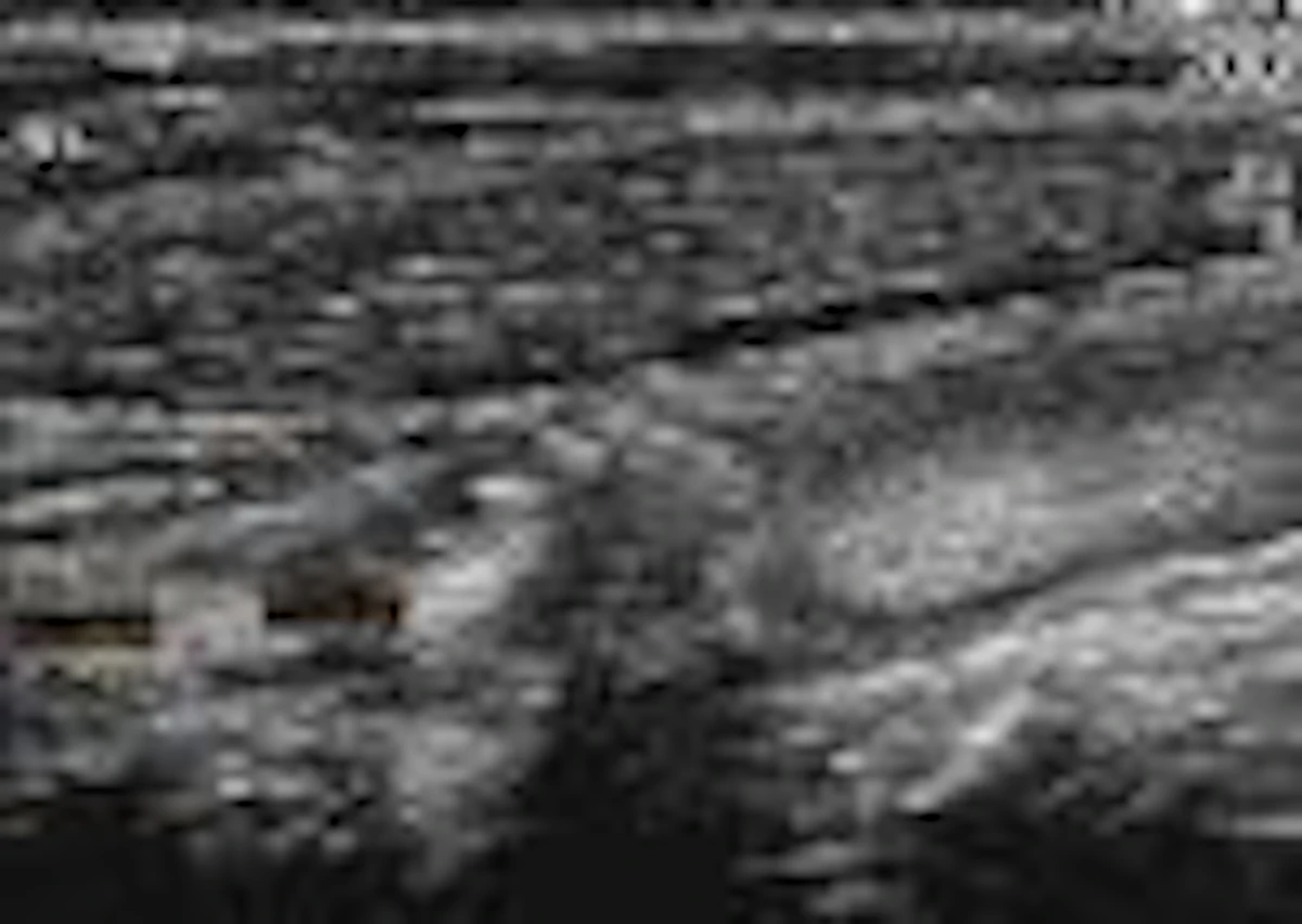B-flow ultrasound shows promise in carotid artery imaging | AuntMinnie