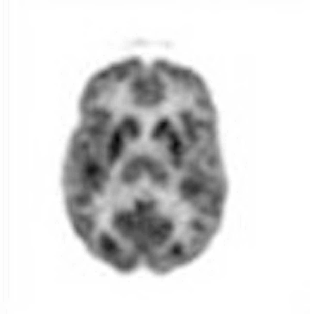 Pioneers reflect on history, future of FDG-PET | AuntMinnie