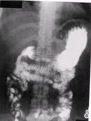 Patient positioning tips for a premium UGI series | AuntMinnie