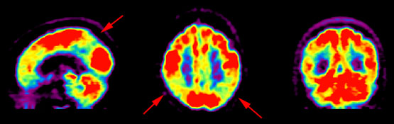 PET CNS Imaging: | AuntMinnie