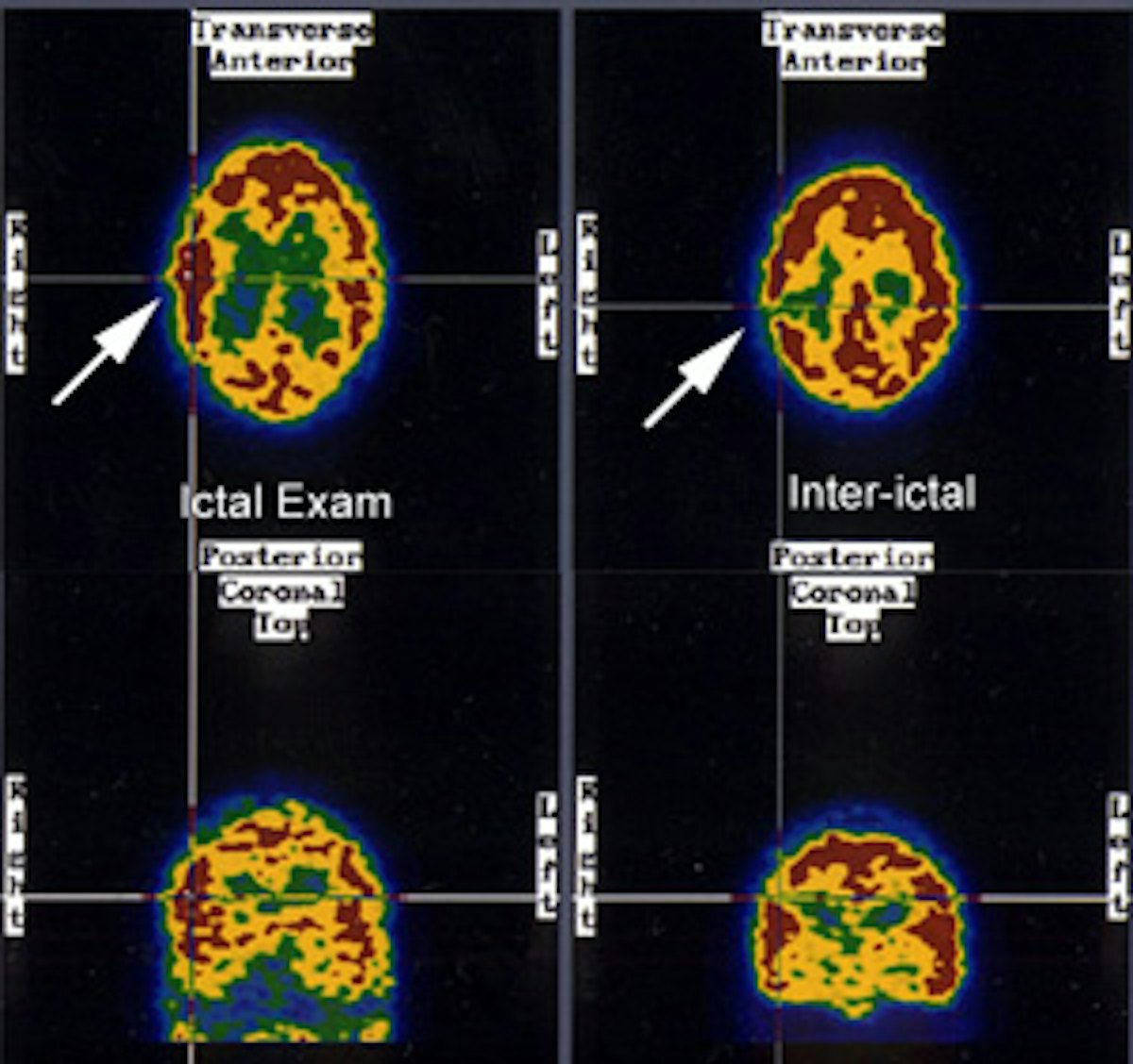Brain SPECT for the Detection of a Seizure focus: | AuntMinnie