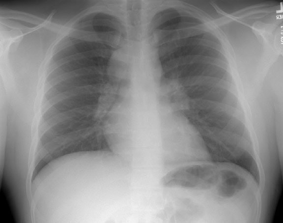Autoimmune Sarcoid Images Sarcoid7 Auntminnie