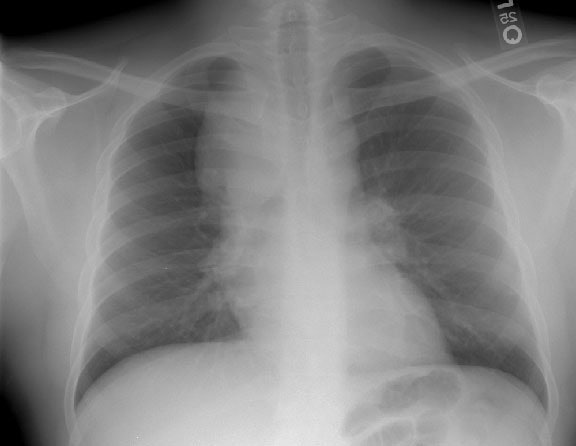 Autoimmune Sarcoid Images Sarcoid7 Auntminnie