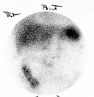 Infection-Inflammation > In-111 WBC | AuntMinnie