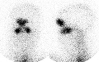 Infection-Inflammation > In-111 WBC | AuntMinnie