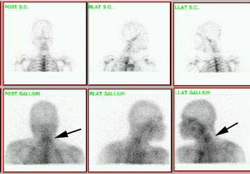 Infection-Inflammation > In-111 WBC | AuntMinnie