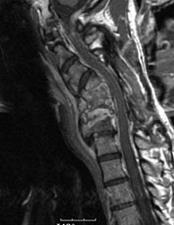Infection-Inflammation > In-111 WBC | AuntMinnie