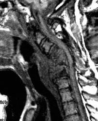 Infection-Inflammation > In-111 WBC | AuntMinnie
