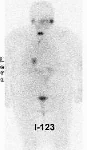I-131 Ablation for Thyroid Neoplasms | AuntMinnie