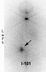 I-131 Ablation for Thyroid Neoplasms | AuntMinnie