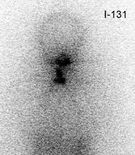 I-131 Ablation for Thyroid Neoplasms | AuntMinnie