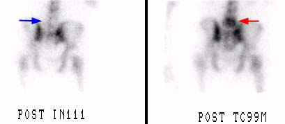 Infection-Inflammation > In-111 WBC | AuntMinnie