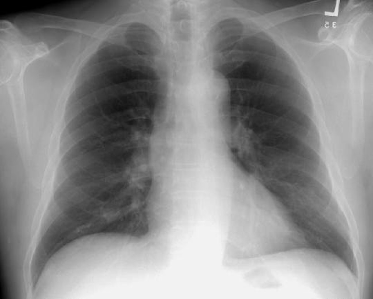 Lymph > MALTOMA > Images > Case1 | AuntMinnie