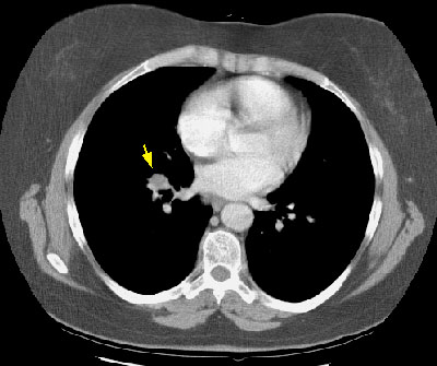 Nodal Status (N) Examples Examples Regional Lymph Node Status (N ...