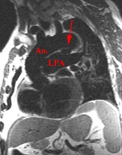 Cardiac > Congenital > PDA > Images > Pda1 | AuntMinnie