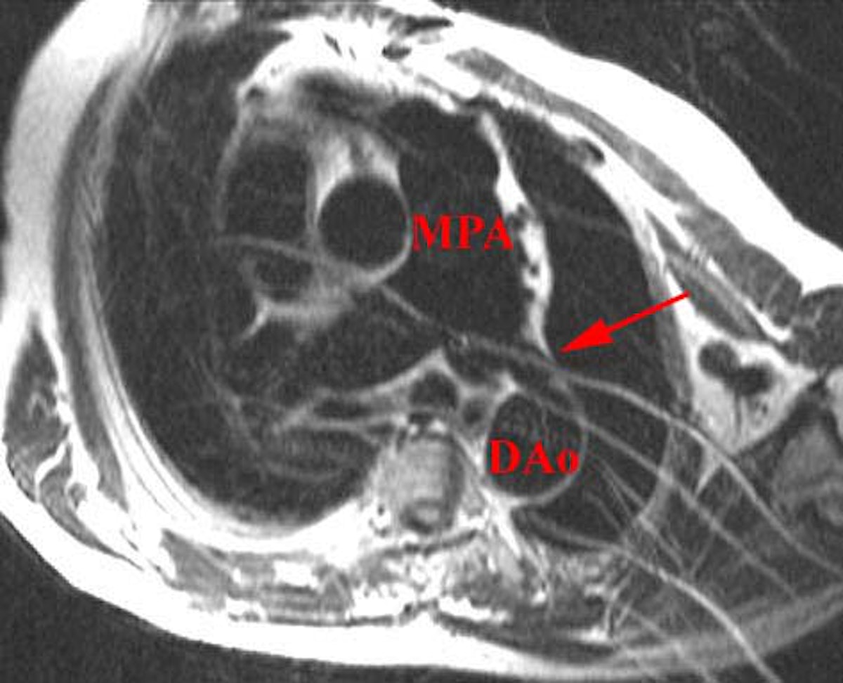 Cardiac > Congenital > PDA > Images > Pda1 | AuntMinnie