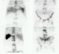 Infection-Inflammation > In-111 WBC | AuntMinnie