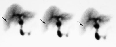 Cholecystitis | AuntMinnie