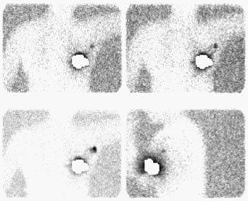 Lymphoscintigraphy | AuntMinnie