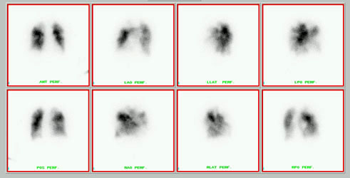 Pulmonary > PE | AuntMinnie