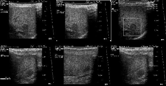 Autoimmune Sarcoid Images Testsarcoid Auntminnie