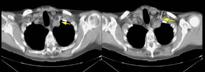 Percutaneous Transthoracic Needle Biopsy | AuntMinnie