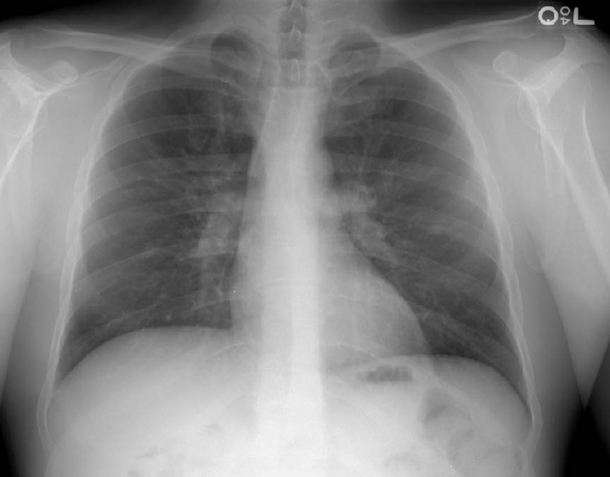 Congenital > CF > Images > Cf3 | AuntMinnie