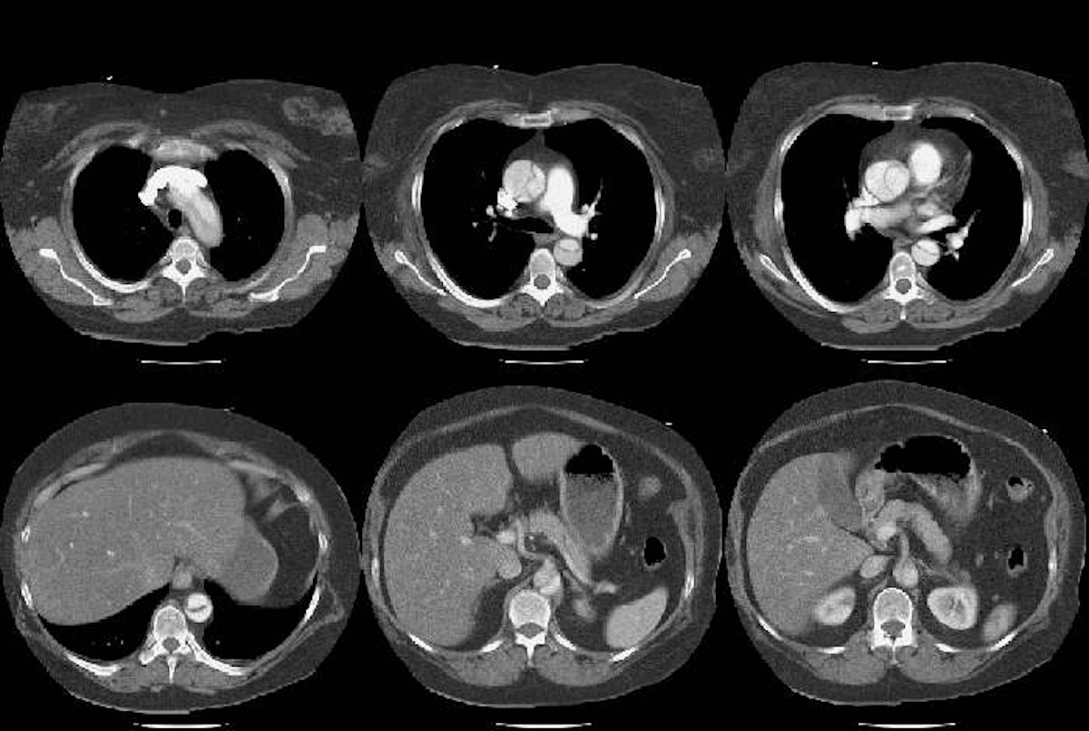 Vascular > Dissection > Images > TypeA > Case1 | AuntMinnie