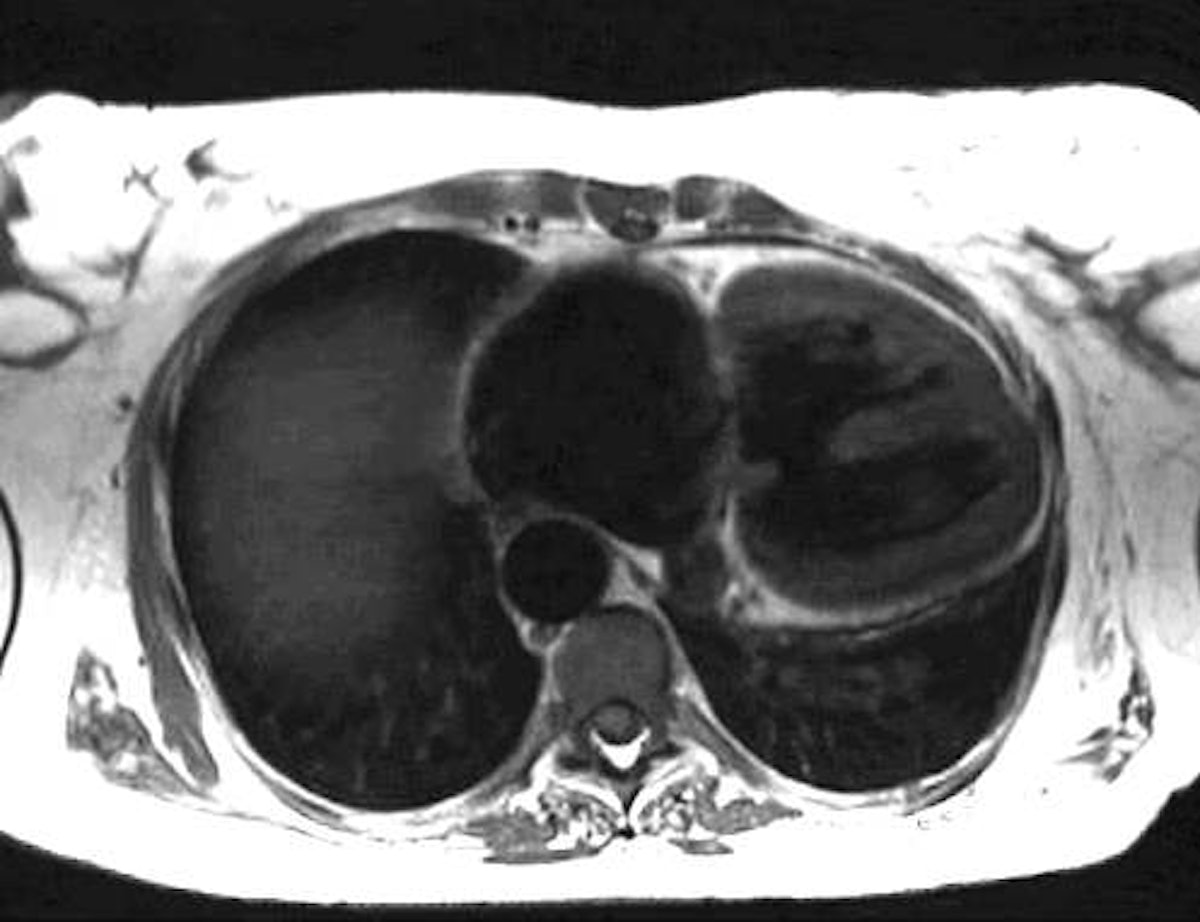 Cardiac > Congenital > VSD > Images > VSD1 | AuntMinnie