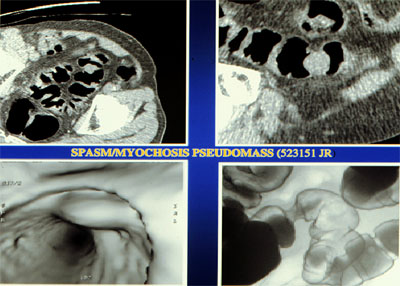 Virtual colonoscopy's tortuous path in diverticular disease | AuntMinnie