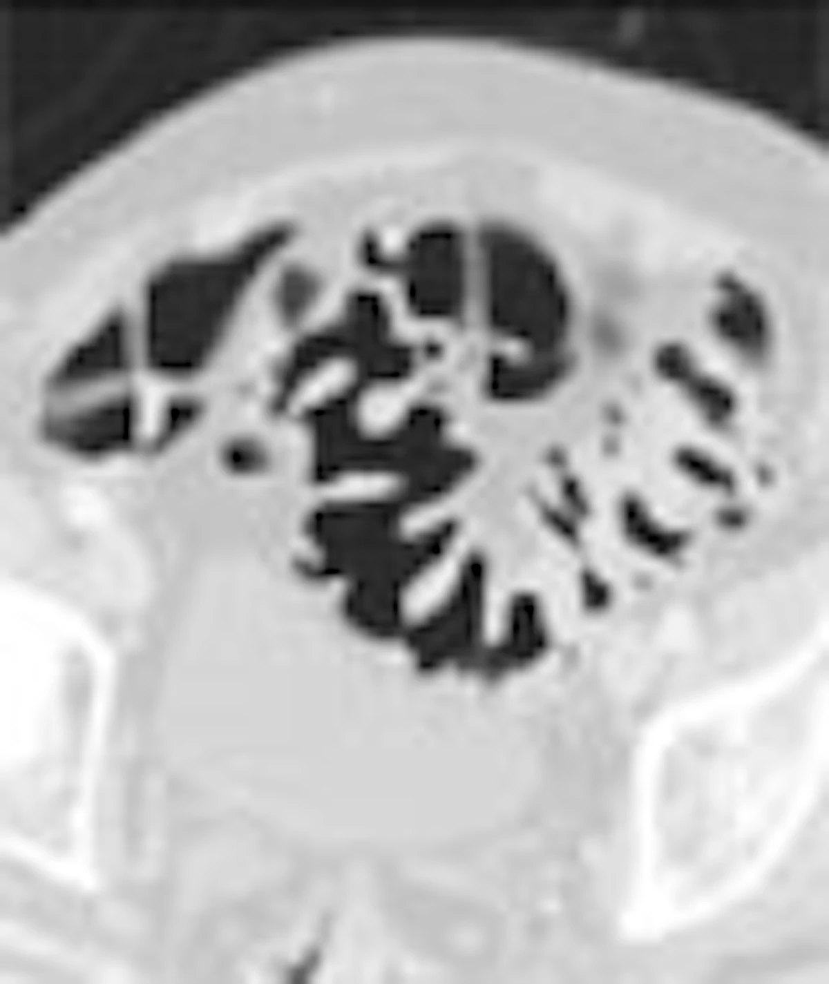 Virtual colonoscopy's tortuous path in diverticular disease | AuntMinnie