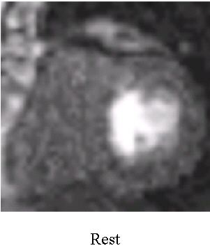 Cardiac MR reveals evidence of subendocardial ischemia in syndrome X ...