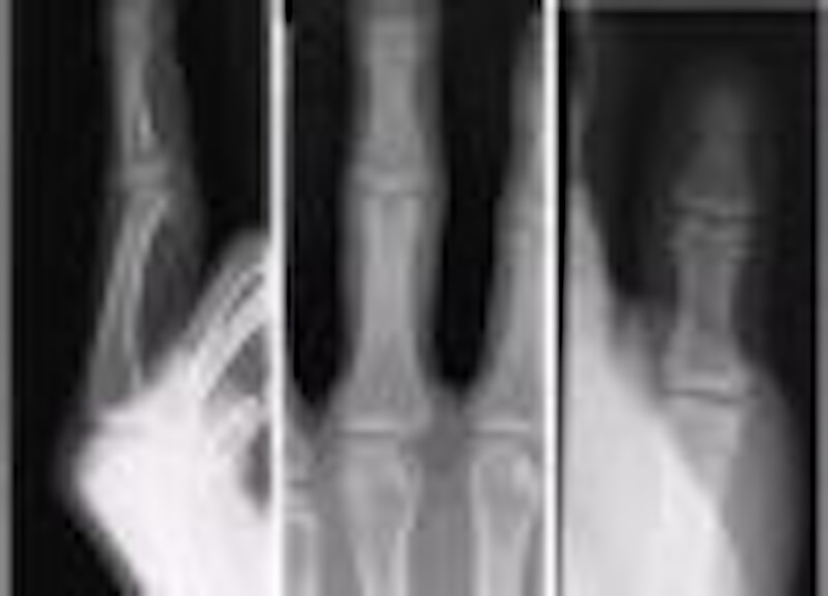 Digit imaging requires diligent positioning | AuntMinnie