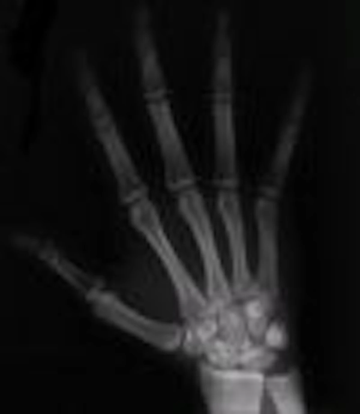 The twists and turns of hand and wrist x-ray positioning | AuntMinnie