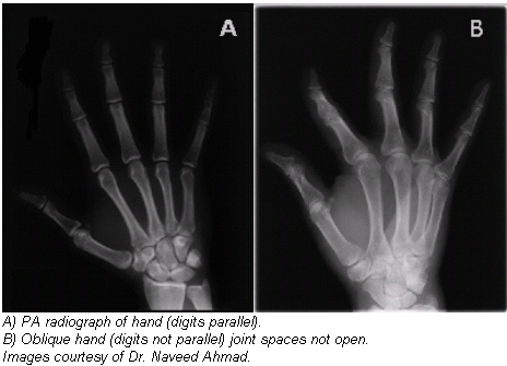 The twists and turns of hand and wrist x-ray positioning | AuntMinnie