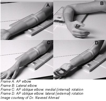 The bends and flexures of forearm and elbow x-ray positioning | AuntMinnie