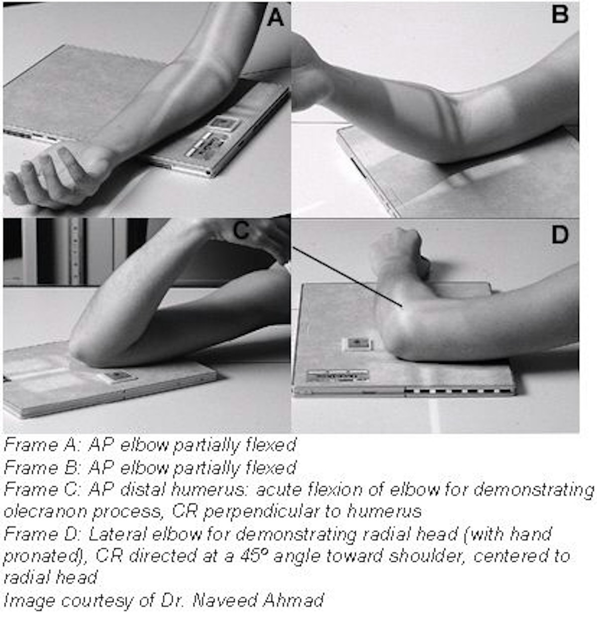 elbow extension angles