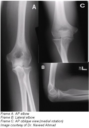 The bends and flexures of forearm and elbow x-ray positioning | AuntMinnie