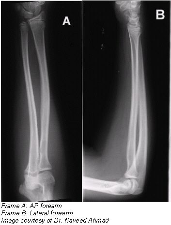 The bends and flexures of forearm and elbow x-ray positioning | AuntMinnie