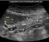 Ultrasound of the pancreas: what normal looks like | AuntMinnie